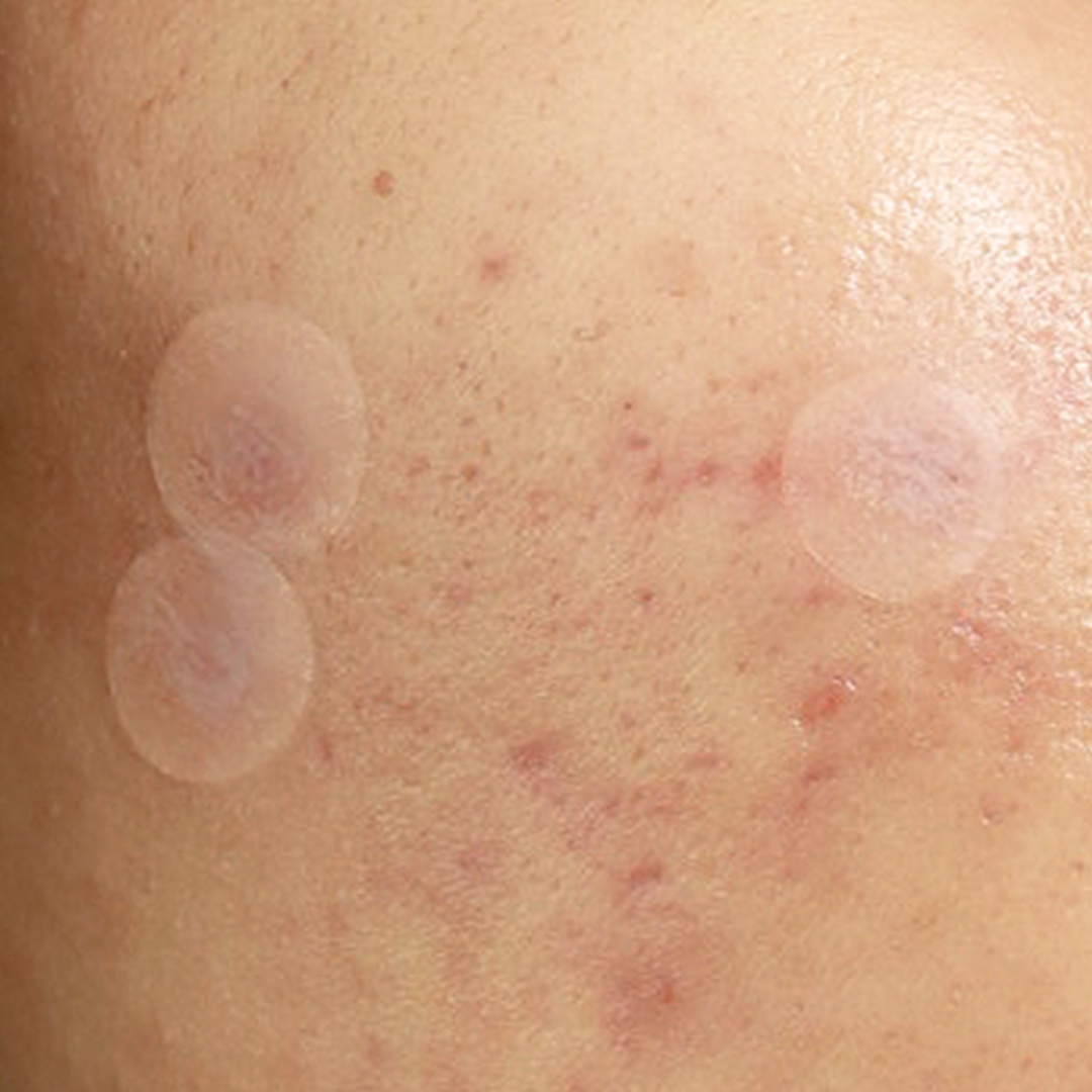 Patch Me Up Waterproof Pimple Patches – Julep